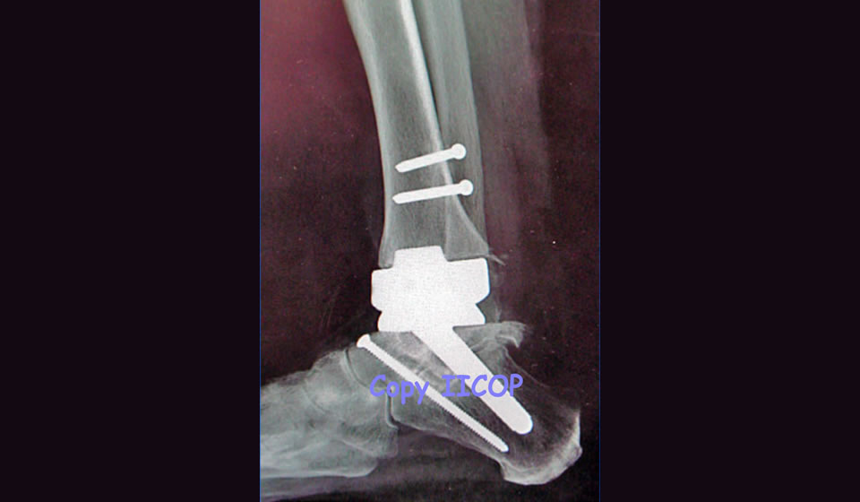 Prtesis Total de Tobillo :: Sociedad Argentina de Medicina y Cirugía de ...